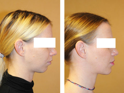 Chirurgie des Mâchoires Paris, Chirurgie Orthognatique Paris