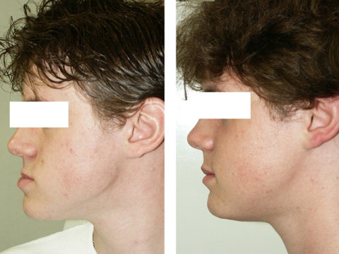 Cas Avant/Après de Chirurgie des Mâchoires à Paris | Classe III