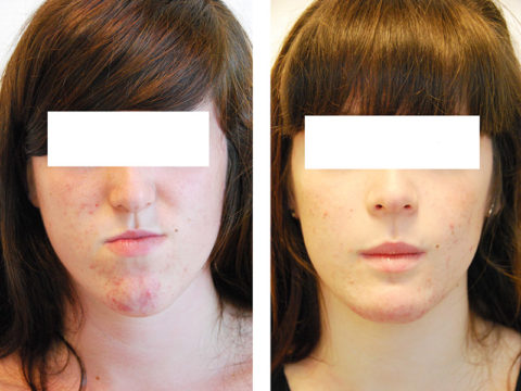 Génioplastie, Chirurgie du Menton à Paris | Cas Avant/Après