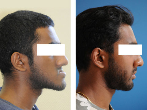 Cas Avant/Après de Chirurgie des Mâchoires à Paris | Classe III