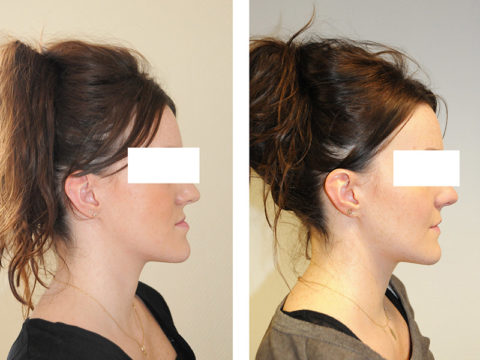 Cas Avant/Après de Chirurgie des Mâchoires à Paris | Classe III