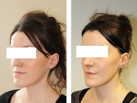 Cas Avant/Après de Chirurgie des Mâchoires à Paris | Classe III