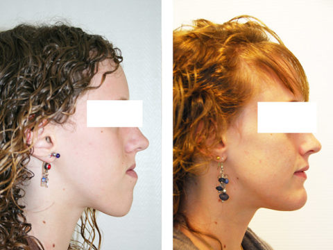 Cas Avant/Après de Chirurgie des Mâchoires à Paris | Classe III