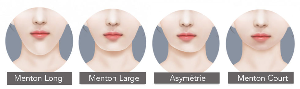 Chirurgie du Menton Paris (Génioplastie) | Techniques, Prix