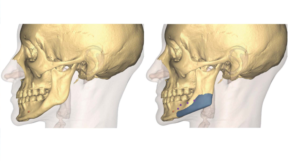 Angles mandibulaires : chirurgie, diagnostic et traitement
