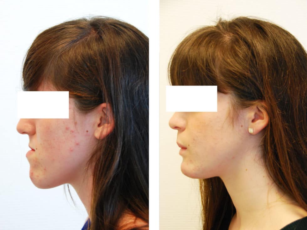 Cas Avant/Après de Chirurgie des Mâchoires à Paris | Classe III