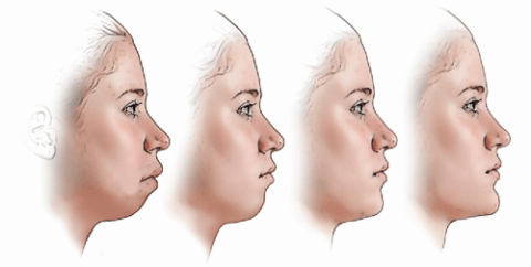 Guide sur le menton fuyant : tout sur le menton fuyant à Paris