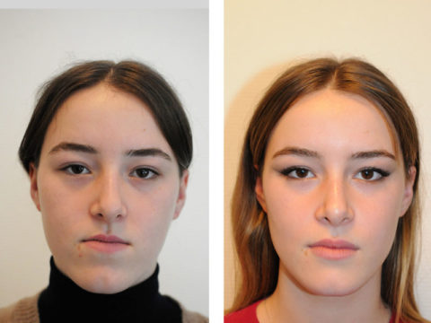 Cas Avant/Après de Chirurgie des Mâchoires à Paris | Classe III