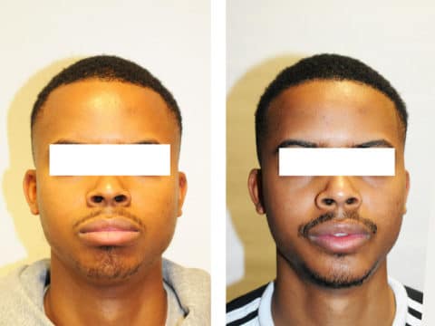 Génioplastie, Chirurgie du Menton à Paris | Cas Avant/Après