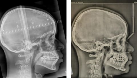 Génioplastie, Chirurgie du Menton à Paris | Cas Avant/Après