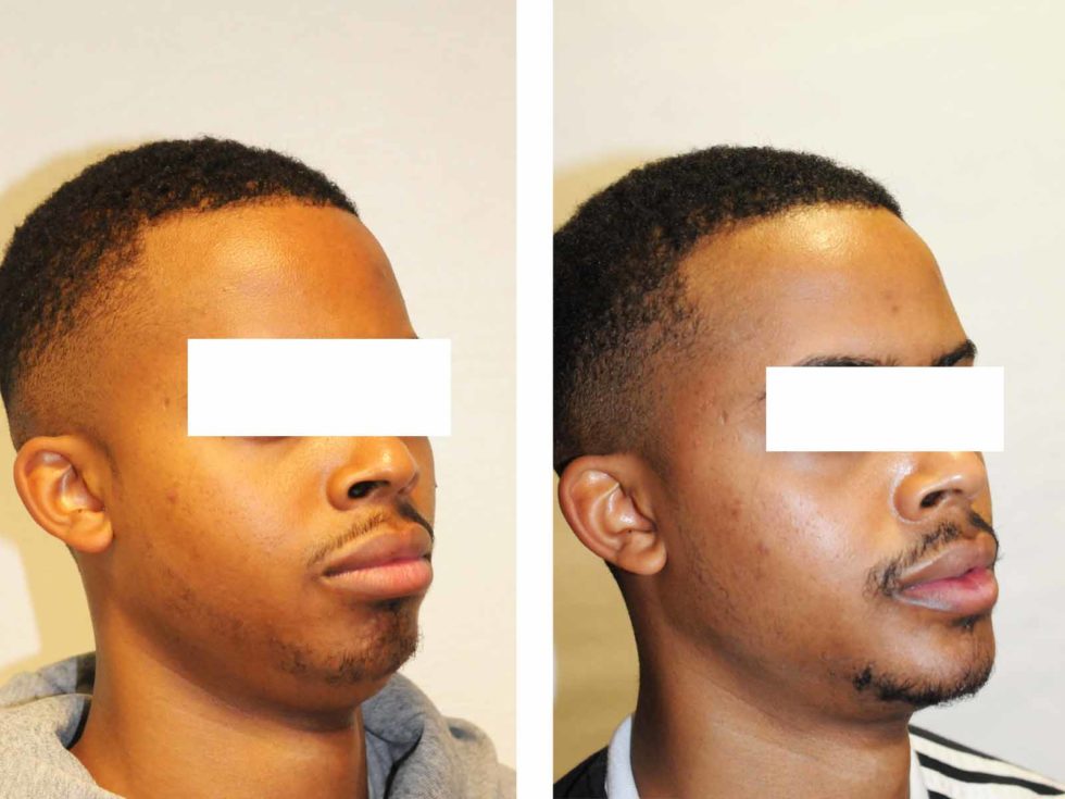 Génioplastie, Chirurgie du Menton à Paris | Cas Avant/Après