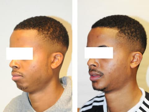 Génioplastie, Chirurgie du Menton à Paris | Cas Avant/Après