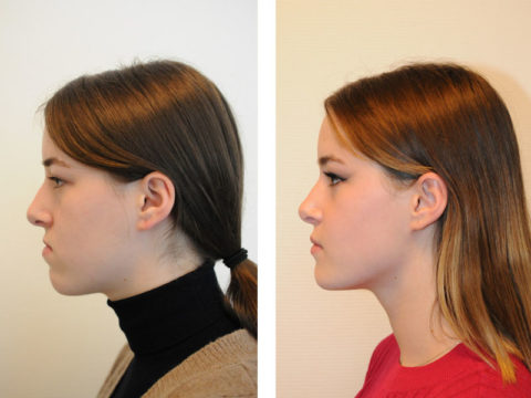 Cas Avant/Après de Chirurgie des Mâchoires à Paris | Classe III