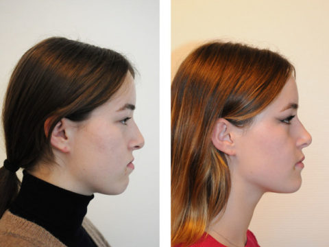 Cas Avant/Après de Chirurgie des Mâchoires à Paris | Classe III