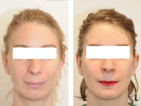 Chirurgie Maxillo-Faciale Paris, Chirurgie du Menton Paris | Classe II