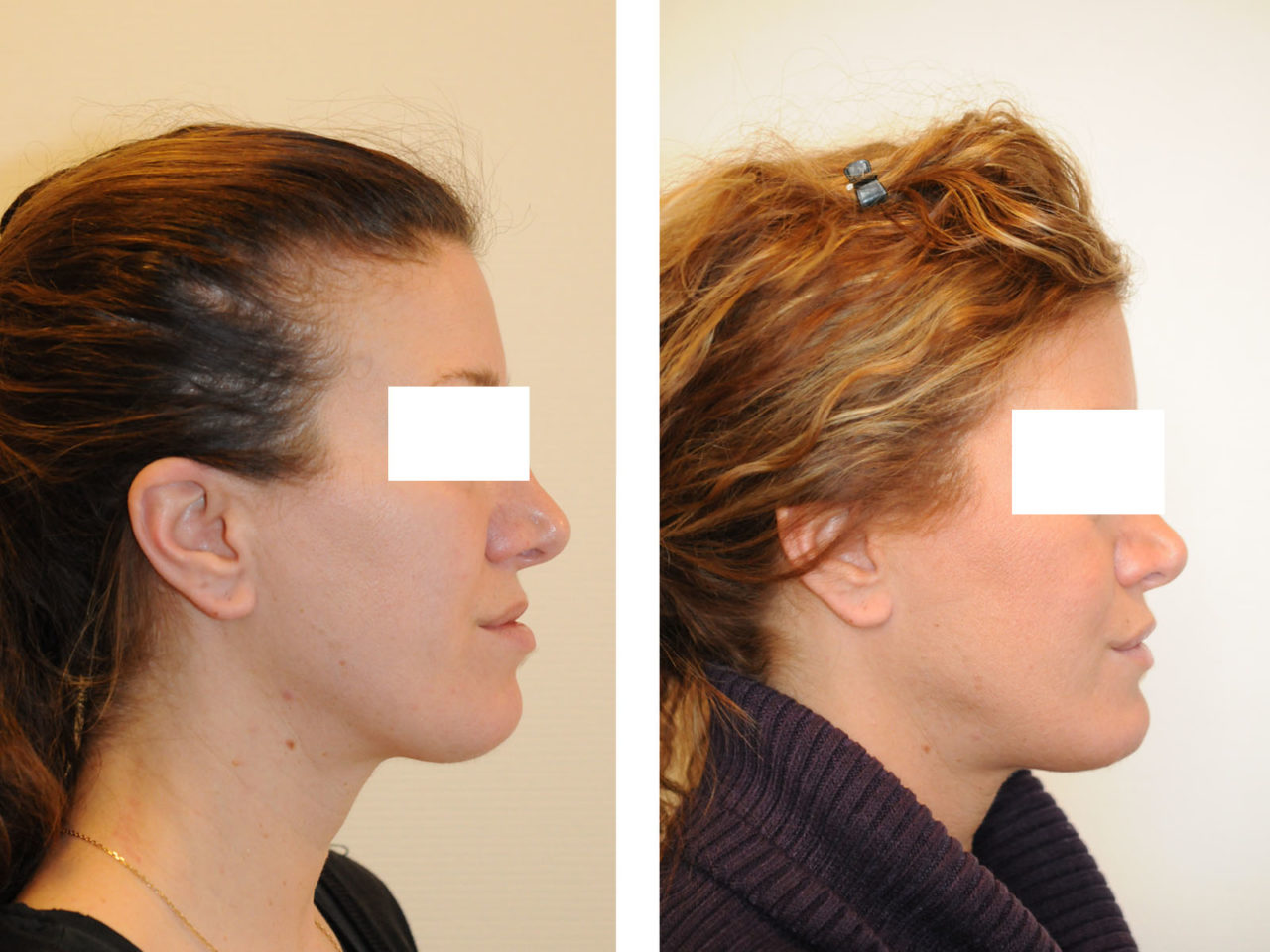 Cas Avant/Après de Chirurgie des Mâchoires à Paris | Classe III